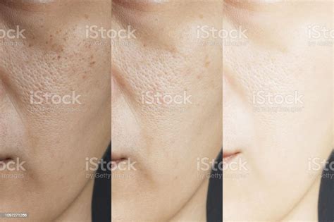 세 사진은 치료 전후 효과를 비교한 것입니다 피부의 트러블을 해소 하기 위해 치료 전후에 주 근 깨 모 공 칙칙한 피부 주름 등의 문제가 있는 피부 개선 결과 피부에 대한