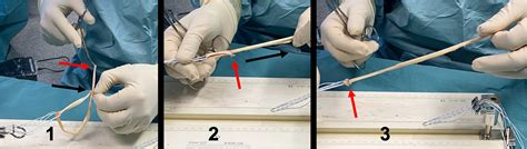 The Lasso‐loop Technique A Simple Way To Attach The Semitendinosus