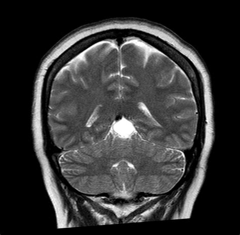 Quadrigeminal Cistern