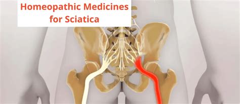 10 Best Homeopathic Medicine For Sciatica