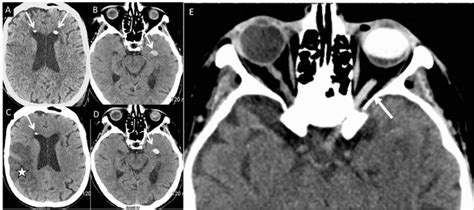 Intraventricular Silicone Oil A Case Report Pmc