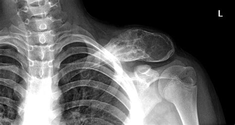 Sarcoma Bone Flat Bone