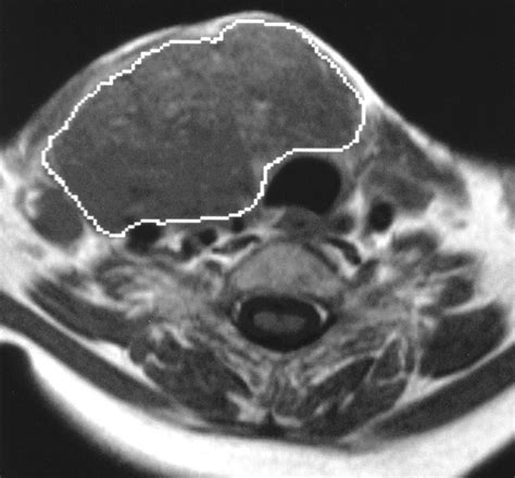 Mr Imaging Of Large Multinodular Goiters Observer Agreement On Volume Versus Observer