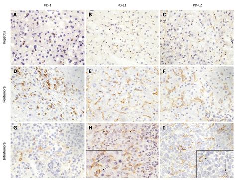 Immunostaining Of Pd 1pd Ls In Liver Tissues Of Patients With