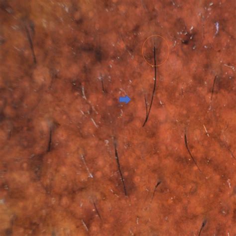 A Dermoscopy Of Melasma Shows Pseudoreticular Pattern Of Brown Download Scientific Diagram