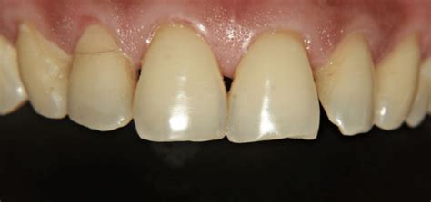 Preoperative Labial Photograph Demonstrating A Fracture With Tooth 12 Download Scientific