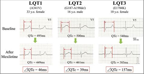 Congenital Long Qt Syndrome Ecg Disease Patterns Medschool 49 Off