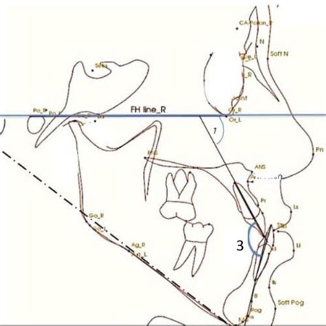 Dental Angular Measurements 1 Ui To Fh 2 Mpa 3 Interincisal Angle