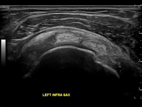 Msk Australia On Linkedin Rotator Cuff Tendon Tear Supra Infra Undersurface Intrasubstance