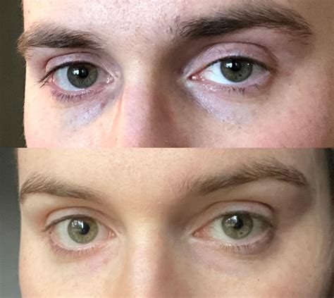 1411 Best Estrogen Images On Pholder Transtimelines Lgbt And 196