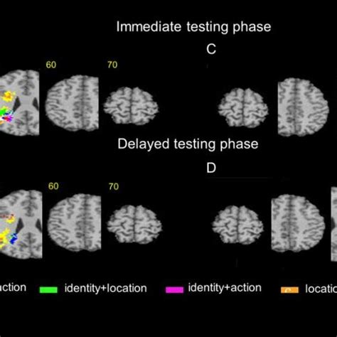 Voxel Based Lesion Behavior Mapping Vlbm Conjunction Analysis