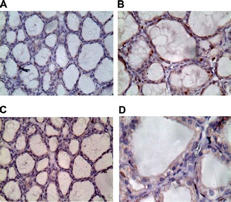 A D Ki67 Staining In Thyroid Tissues At High Magnification Power
