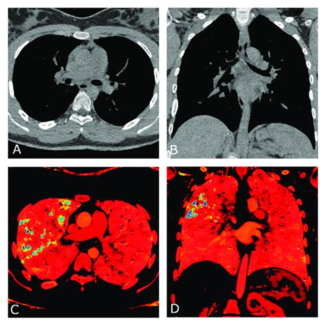 Chest Ct Angiography With Ecg Gating Performed On A Dual Layer Dect