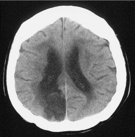 Cranial Computerised Tomography Showing Bilateral Hyperostosis Of The
