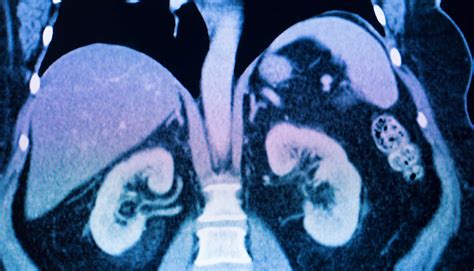 Mri Contrast Agent Detects Early Stage Liver Cancer Futurity