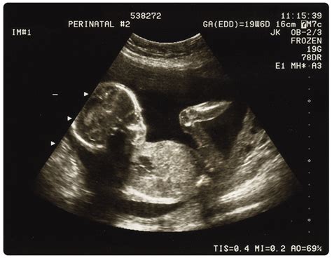 20 Weeks Pregnant Ultrasound 20 Week Ultrasound We Had Our 20 Week