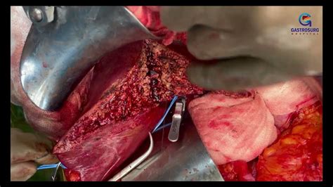 Left Hepatectomy Youtube