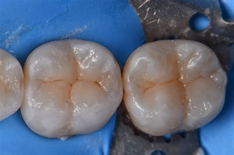 Rapid Sequence Layering Using A Supercomposite By Voco