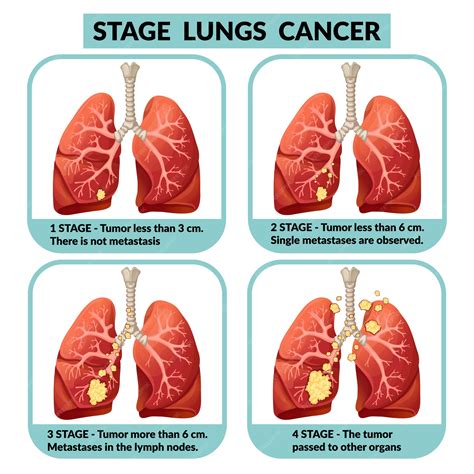 Stages Of Lung Cancer Diagram