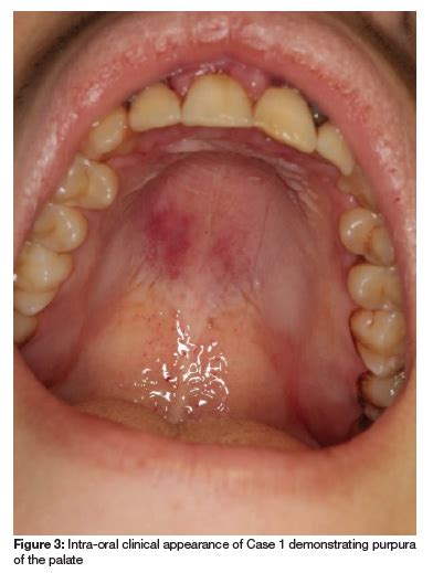 Oral Petechiae