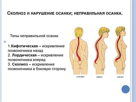 Оздоровительно профилактическая гимнастика при нарушении осанки и плоскостопия презентация онлайн