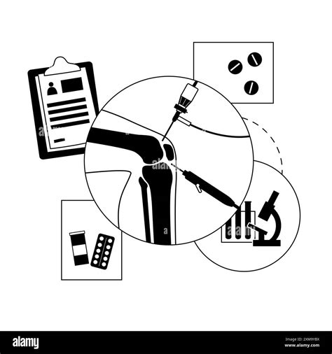 Illustration Of Knee Joint Arthroscopy Procedure This Is A Procedure