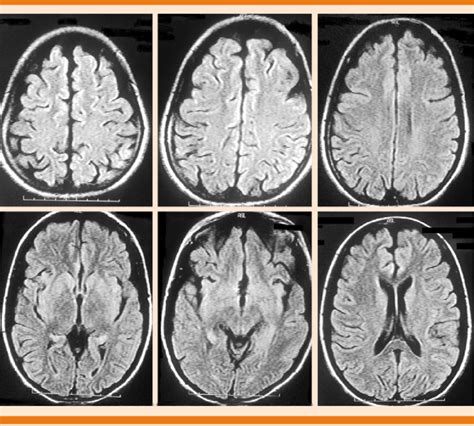 Atrofia Cerebral Global Download Scientific Diagram