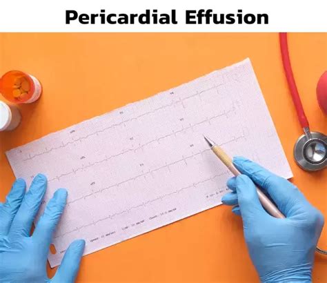 Pericardial Effusion Health Advisor