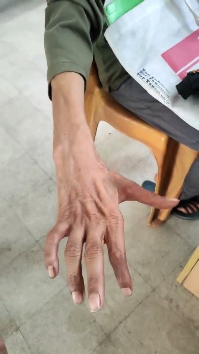 ∆ Mnd Or Something Else Write Your Diagnosis Phalageal Joint