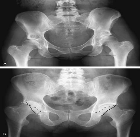Acetabular Osteotomy Indications And Results Clinical Orthopaedics