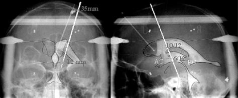 Correlation Between Microelectrode Recording And Clinical Effects Of High Frequency Stimulation