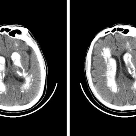 Computed Tomography Of The Brain Showed Multiple Calcifications In The