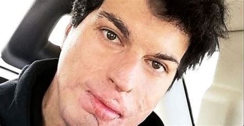Ignacio Lastra Reveló Que Sufrió Bullying Después De Su Accidente