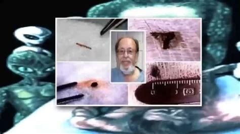Dr Roger Leir implantes alienígenas en supuestos abducidos