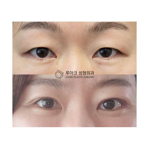 루아크성형외과 수술정보 부분절개지방제거 라이트 하안검 사진경과시점 1⃣수술전
