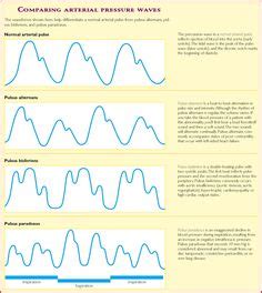 Arterial Line Square Wave Testing Medical Menagerie Icu Nursing