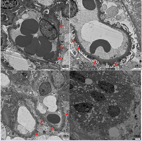 Glomerular Findings By Electron Microscope Under An Electron
