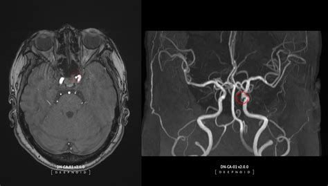 딥노이드 뇌동맥류 뇌영상검출·진단보조소프트웨어 딥뉴로 Deep Neuro 혁신의료기술 선정