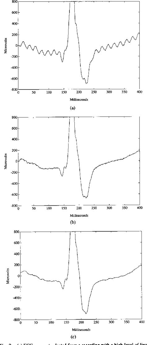 Figure 2 From Removal Of Power Line Interference In Signal Averaged Electrocardiography Systems