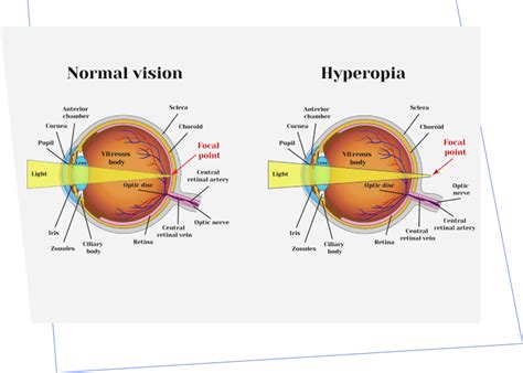 Hyperopia Treatment And Solutions Vision Clinic Sydney