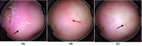 A Diffuse Erythema White Arrow Yellow Globules Or Yellow Tears Download Scientific Diagram
