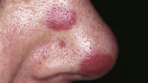 Std Rash On Face Pictures 12 Preventable Stds Pictures Symptoms Diagnosis Treatment Visual