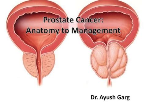 Prostate Cancer Cause Defined Symptom Risk Factors