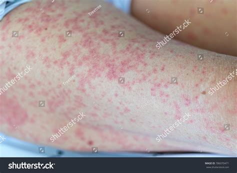 2 286 Drug Rash Images Stock Photos Vectors Shutterstock