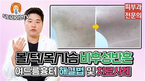 볼 턱 목 가슴 💥흰색 비후성반흔💥 여드름흉터 새로운 레이저 및 치료 사례 Youtube