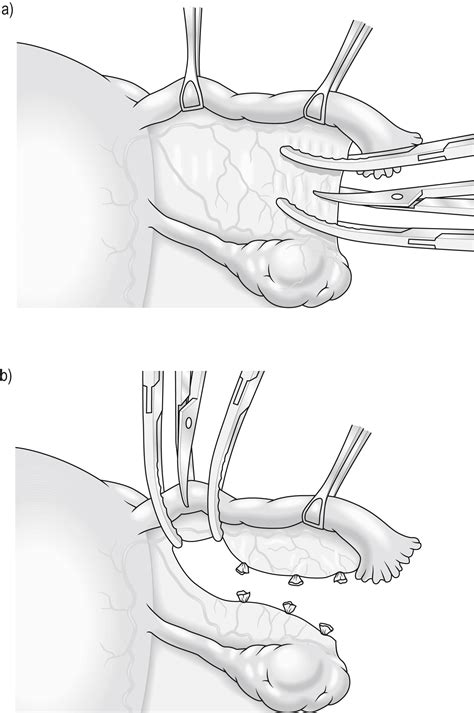 Additional Procedures At Caesarean Section − Salpingectomy Myomectomy