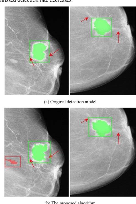Figure 3 From A Breast Cancer Ct Image Detection Algorithm Based On