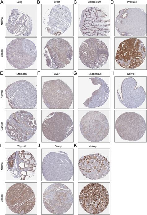 The Immunohistochemistry Showed The Protein Expression Of Gins1 In 11 Download Scientific