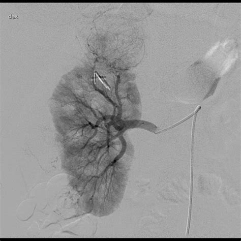 Pdf Elective Embolization For Prevention Of Hemorrhage From Renal Angiomyolipomas