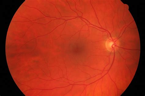 Glaucoma Object Detection Model By Glaucoma